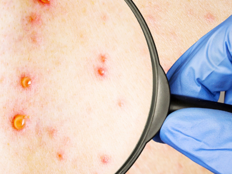 ‘Risk of monkeypox is becoming real and concerning’