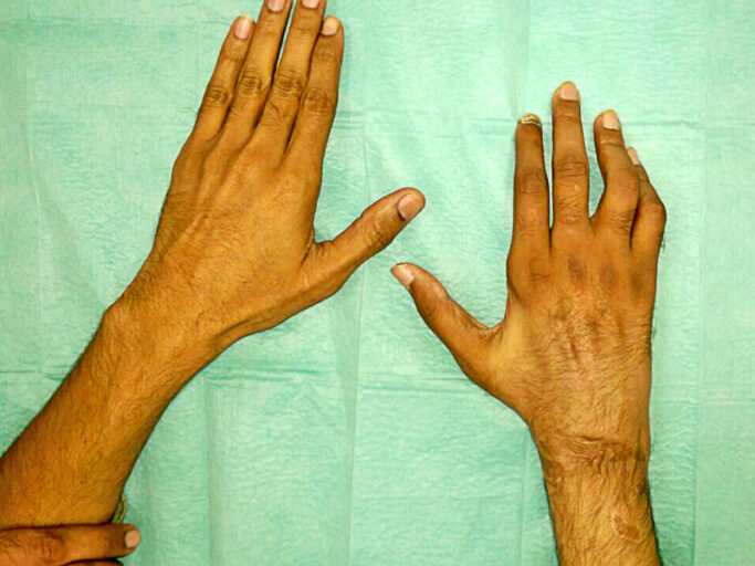 Doctors at Khoula Hospital reattach hand in complex surgery